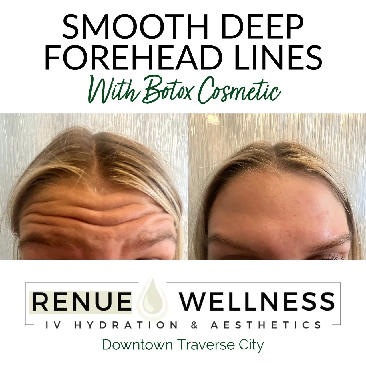 Botox®, Traverse City — RENUE Wellness | IV Hydration + Aesthetics in ...