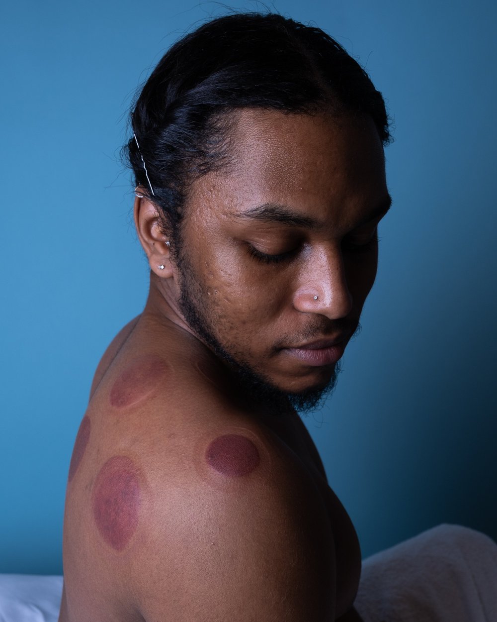Cupping: What To Expect And Aftercare — Emily Grace Acupuncture | New ...
