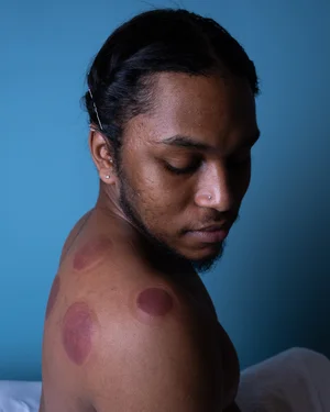 Cupping: What To Expect And Aftercare — Emily Grace Acupuncture | New ...
