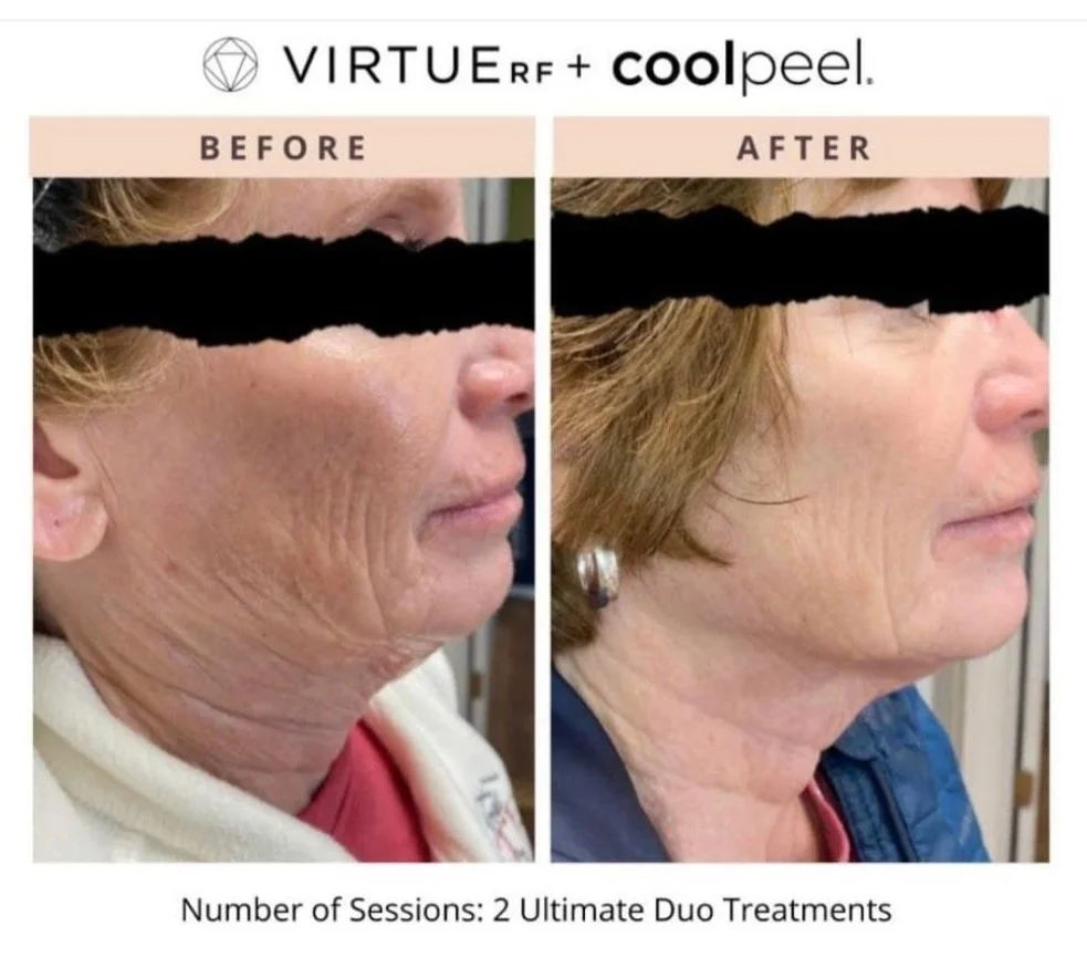 The Ultimate Duo: Hydrafacial & Dermaplaning in Acworth, GA – The Spa ...