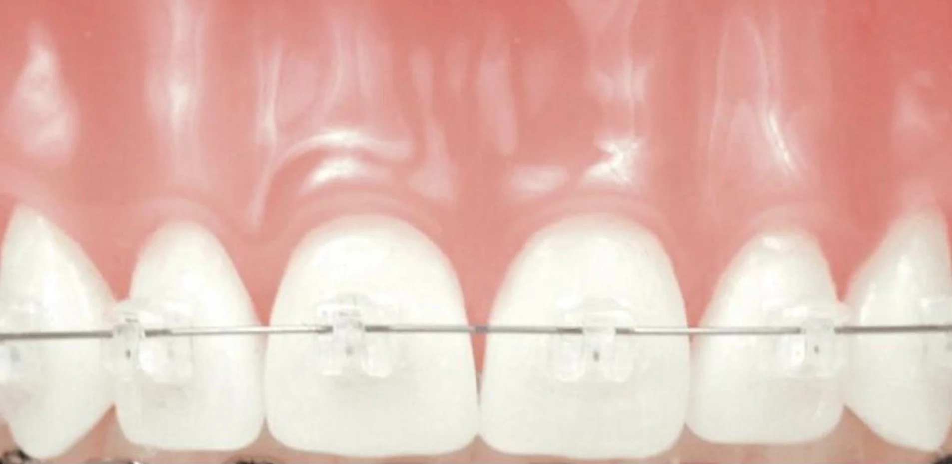 Explore The Benefits Of Traditional Fixed Braces For Teeth