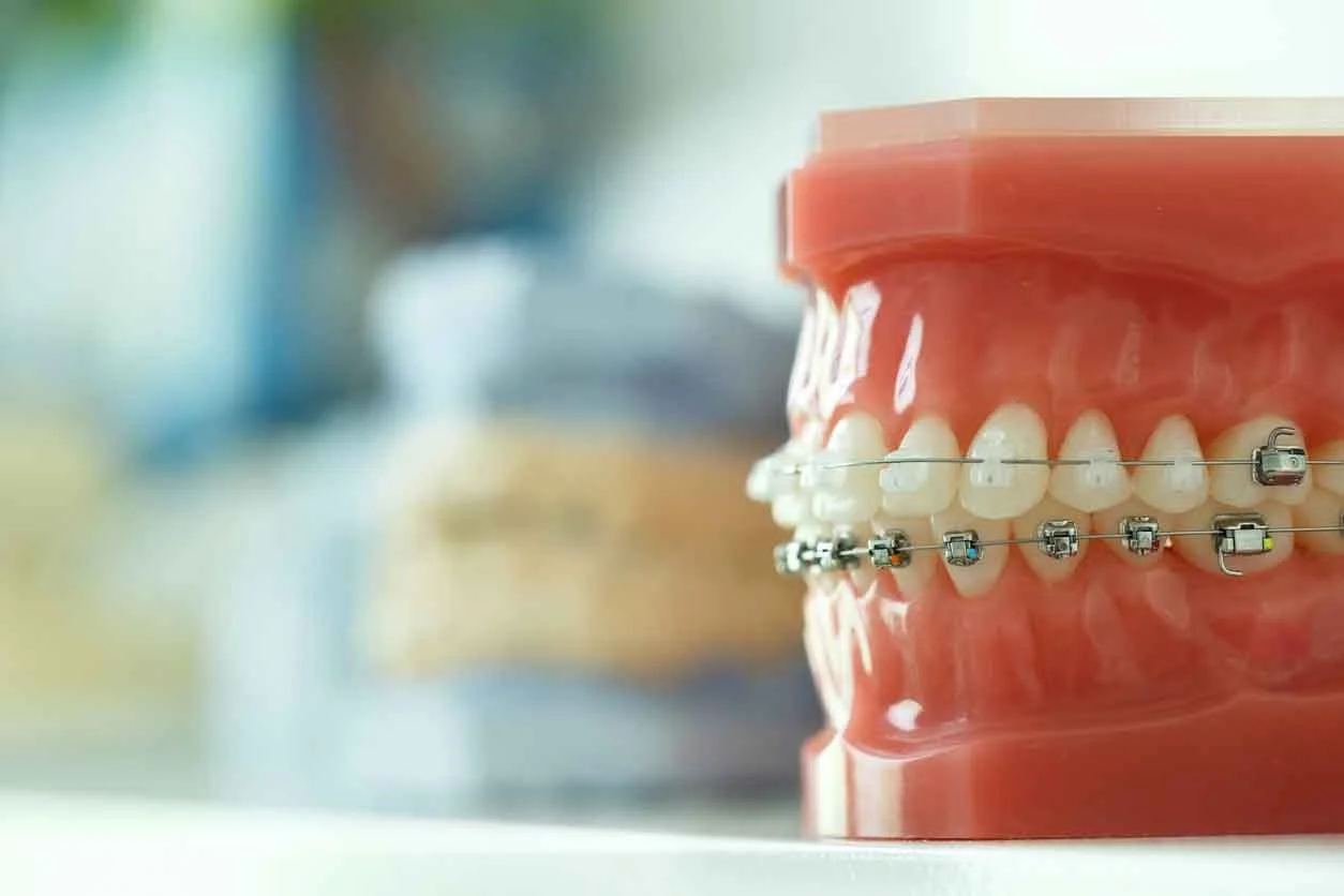 Unveiling Orthodontics: How Does Orthodontics Work?