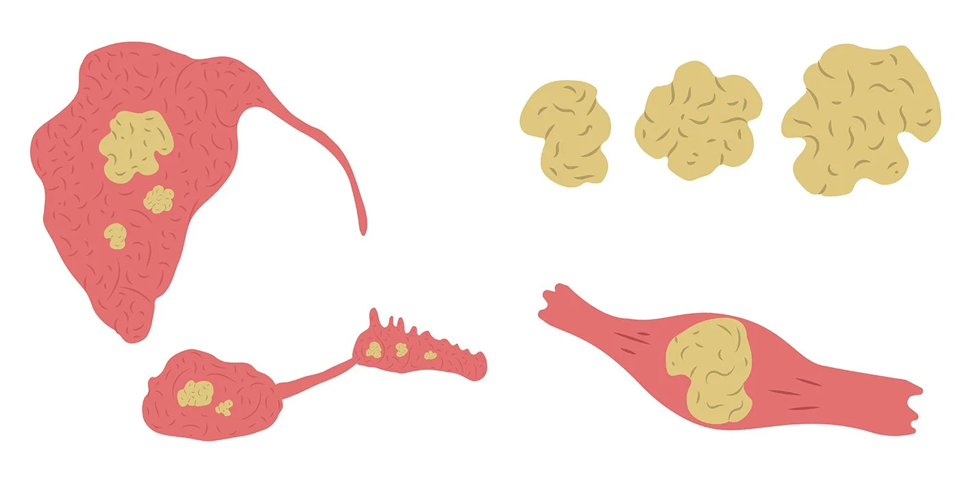 Salivary Gland Stones — Dr Timothy Manzie | Maxillofacial Surgeon ...