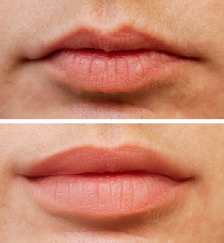 Volumenaufbau mit Hyaluron — Dr. med. Pfeiffer