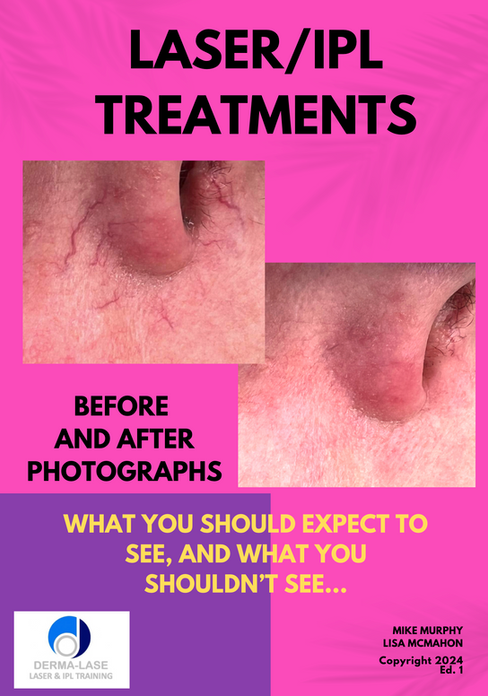 A Brief Guide to Lasers & IPLs — Dermalase Training
