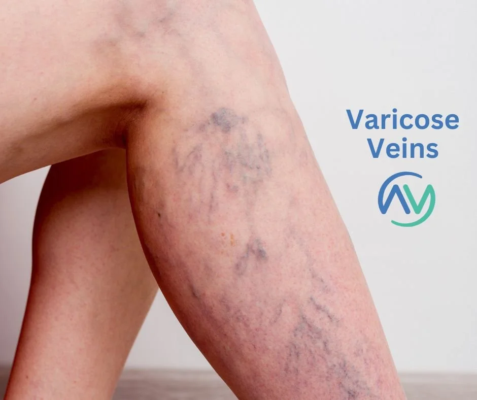 Understanding the Connection Between Varicose Veins and Restless Leg ...