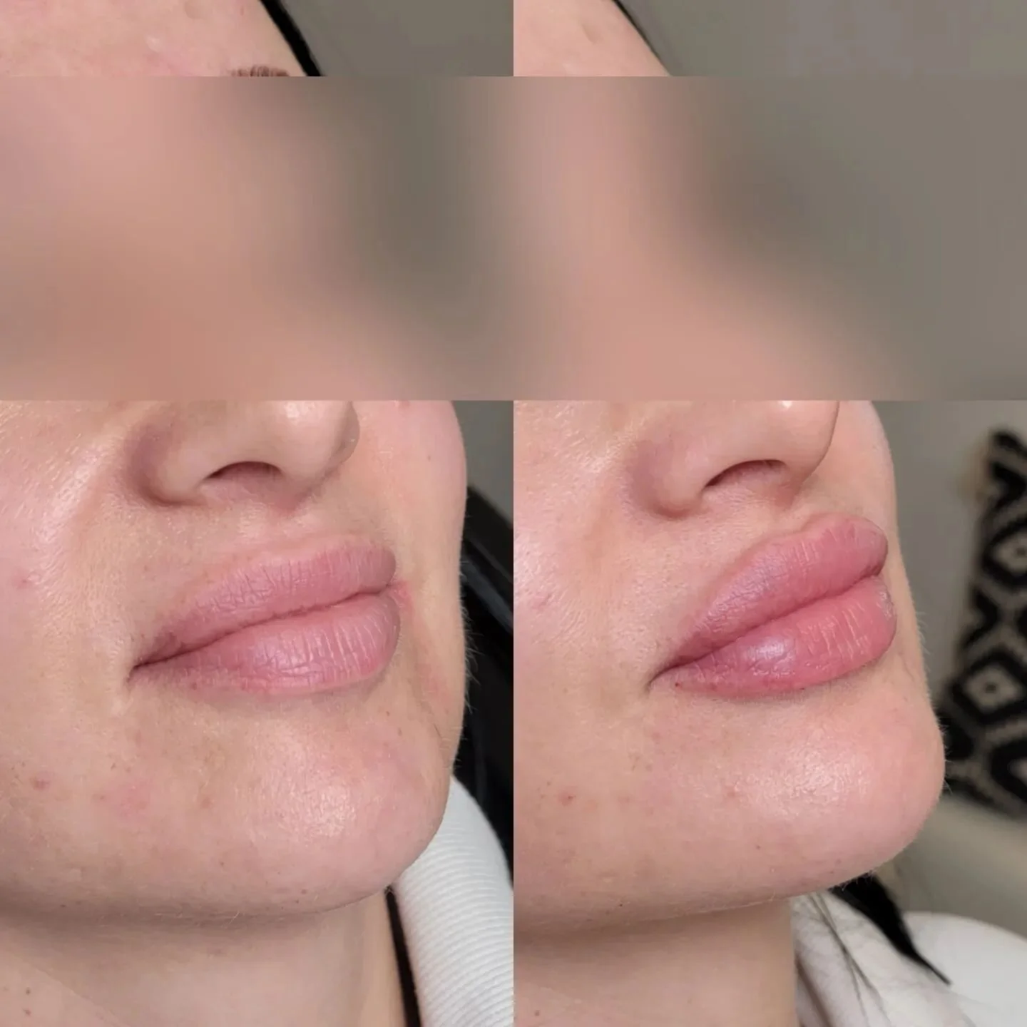 Hydrafacial — KW Beauty