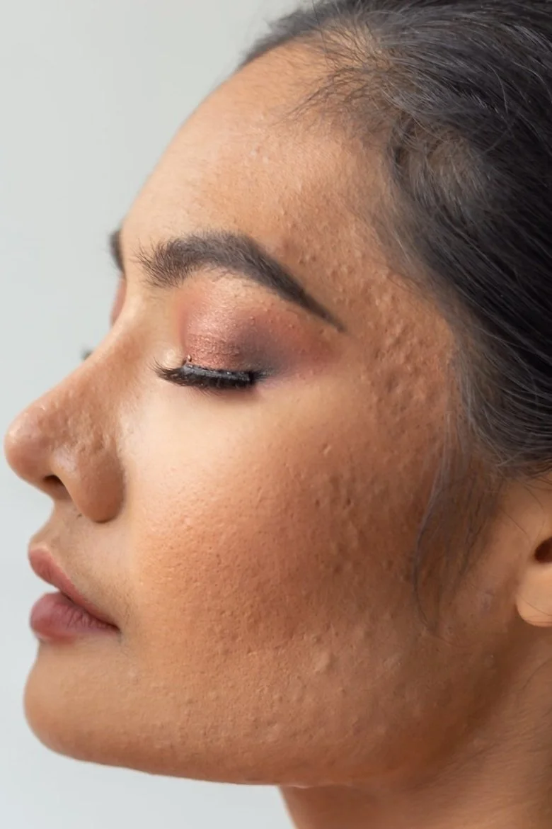 Subcision for Deep Acne Scars | Toronto and Whitby Medical Aesthetics ...