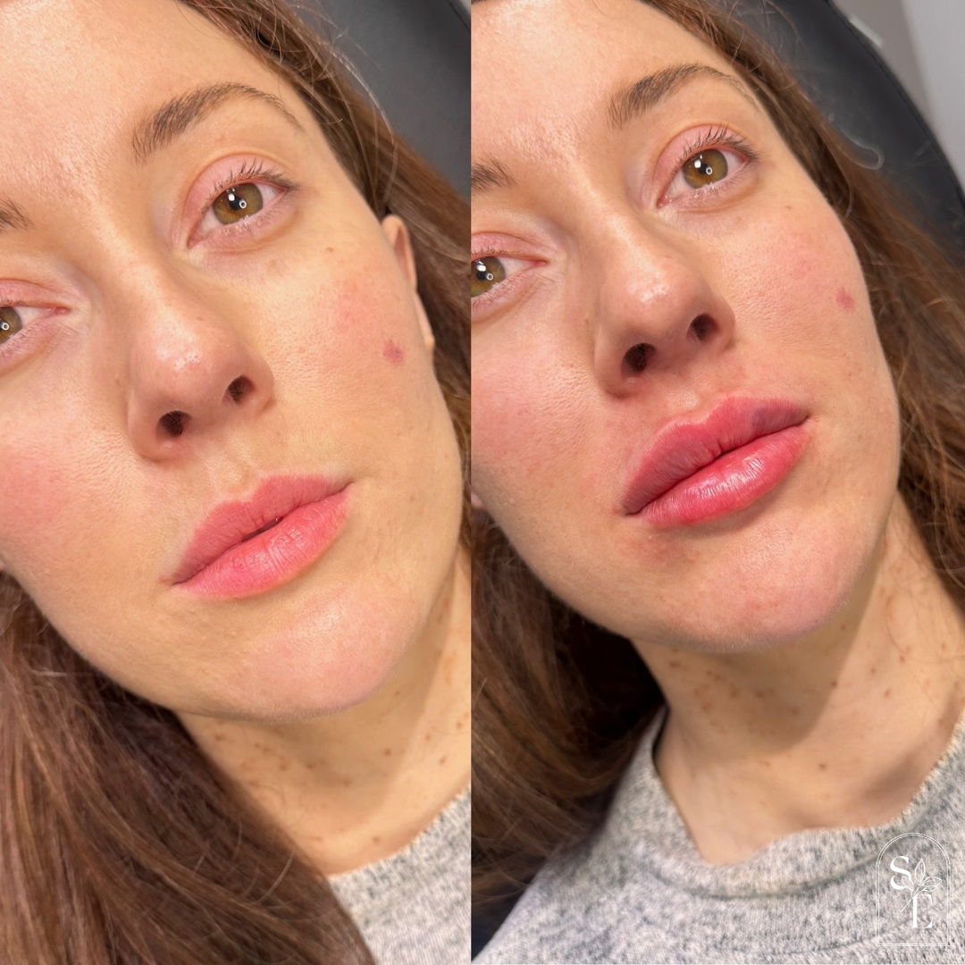 Lip Filler in Toronto: Why the Lower Face Matters Too — Subtle Enhancements