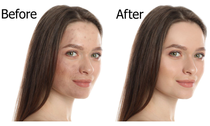 Chemical Peels for Youthful Skin | Effective Exfoliation Treatments ...