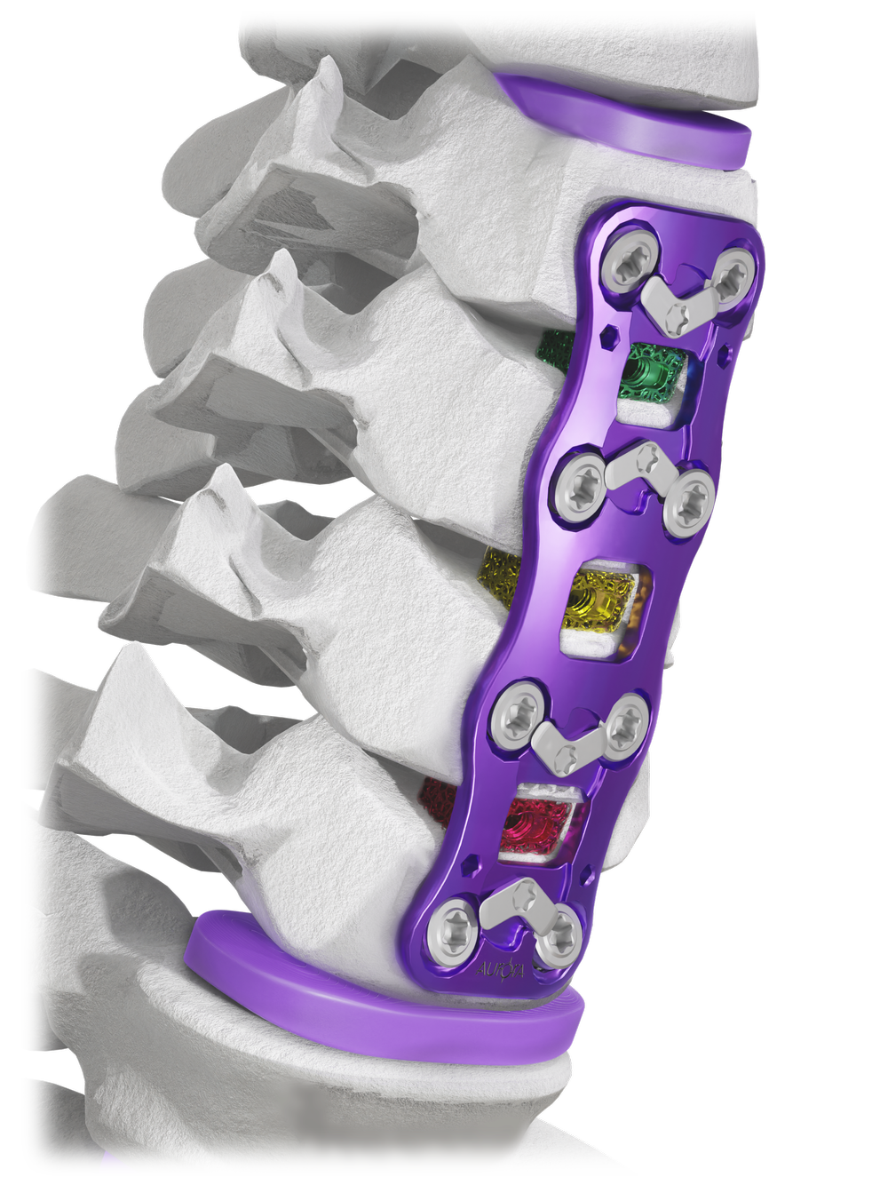 apollo™ Cervical System — Aurora - Simplifying The Complex - Spine and ...