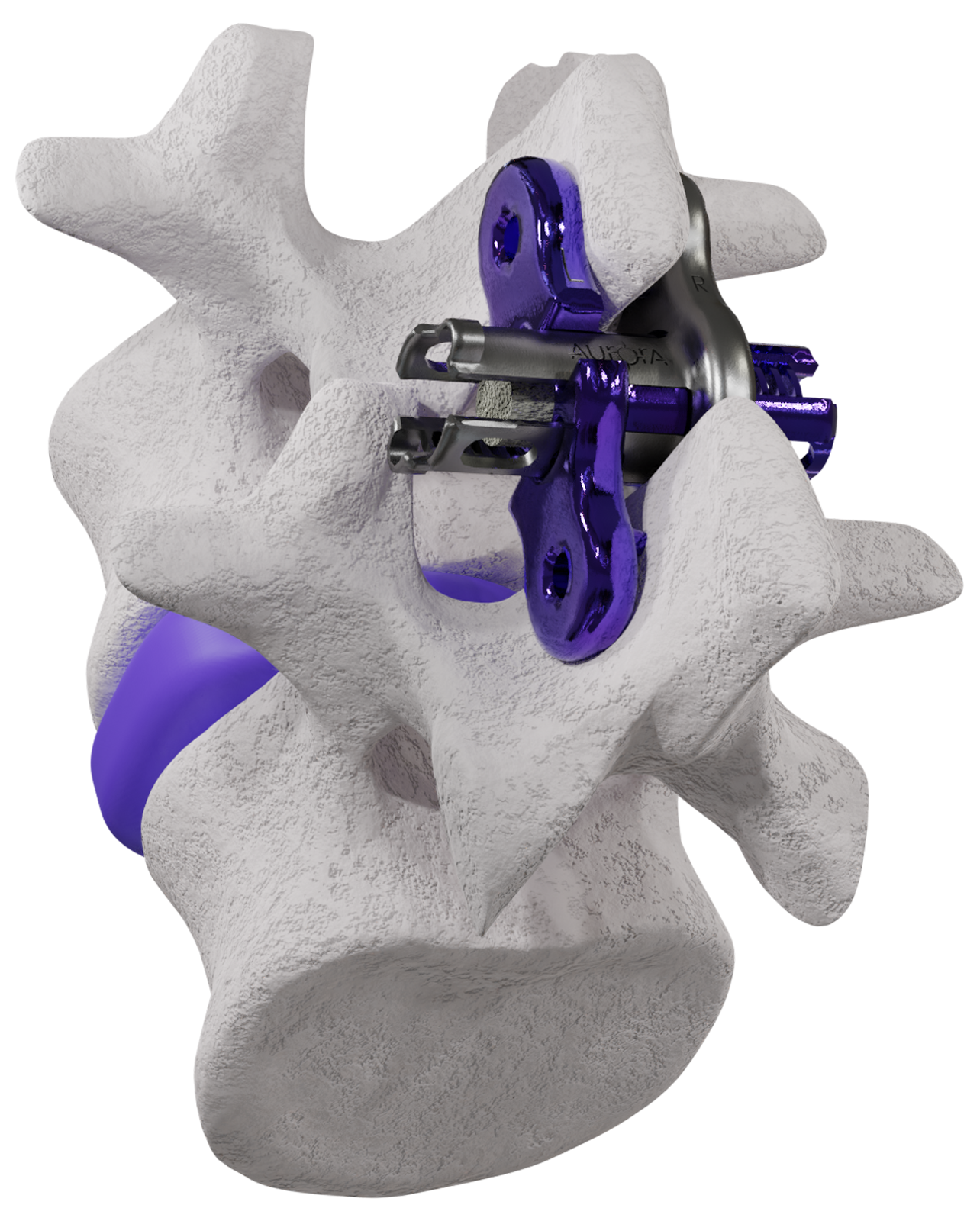 zip™ Minimally Invasive System — Aurora - Simplifying The Complex ...