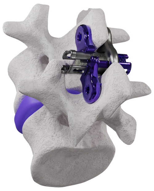 zip™ Minimally Invasive System — Aurora - Simplifying The Complex ...