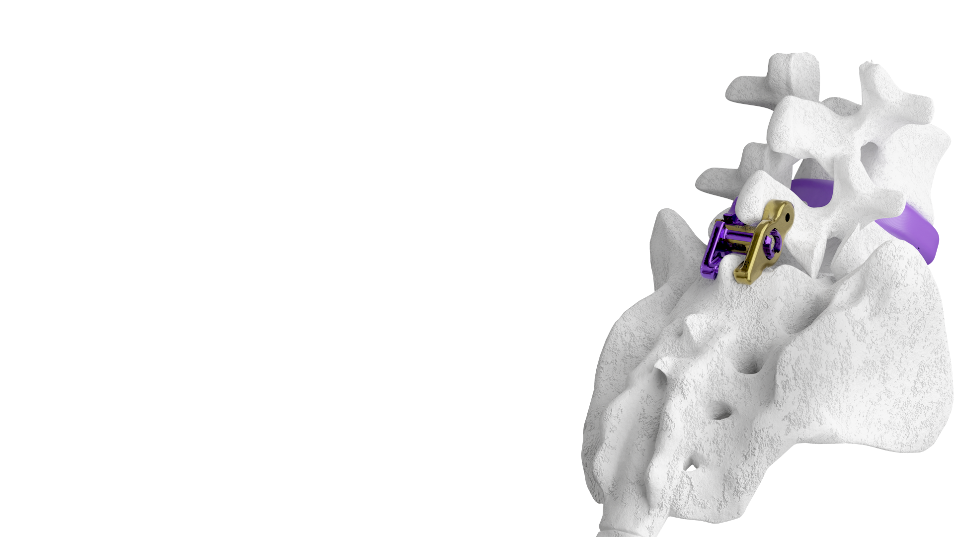 zip™ Minimally Invasive System — Aurora - Simplifying The Complex ...