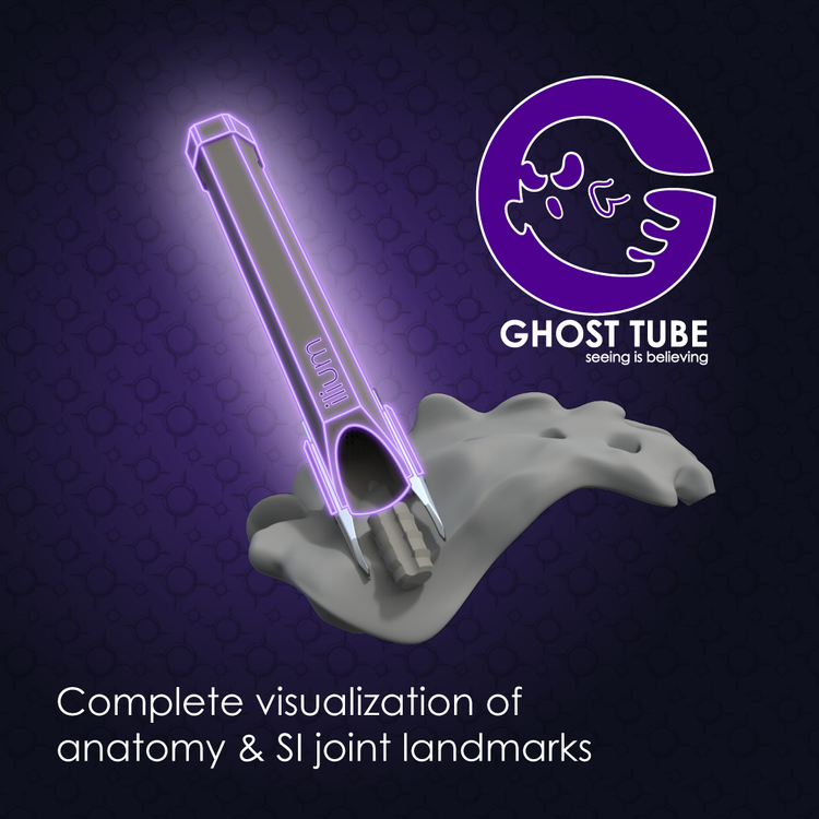 SiLO™ Allograft - Sacroiliac Joint Fusion — Aurora - Simplifying The ...