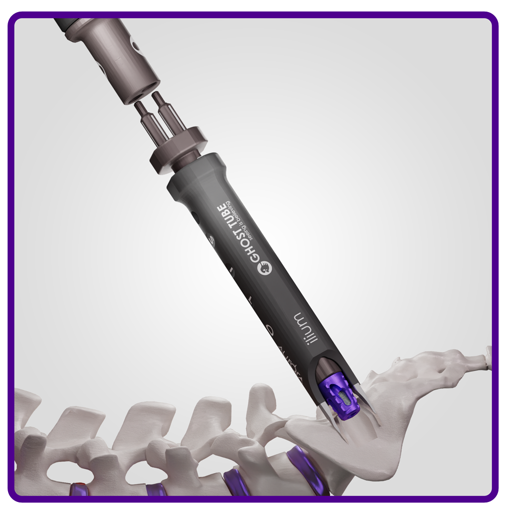 SiLO TFX™ - Transfixing The SI Joint — Aurora - Simplifying The Complex ...