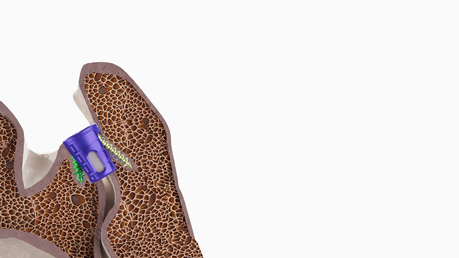 SiLO TFX™ - Transfixing The SI Joint — Aurora - Simplifying The Complex ...