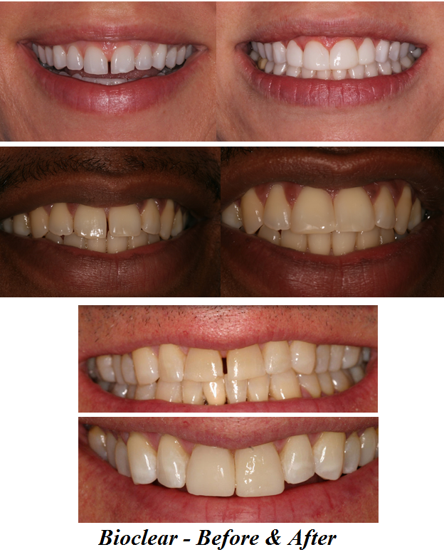 Bioclear — Aesthetic Dental Zone