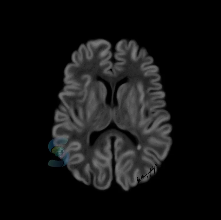 Periventricular Nodular Heterotopia — Society of Pediatric Neuroimaging