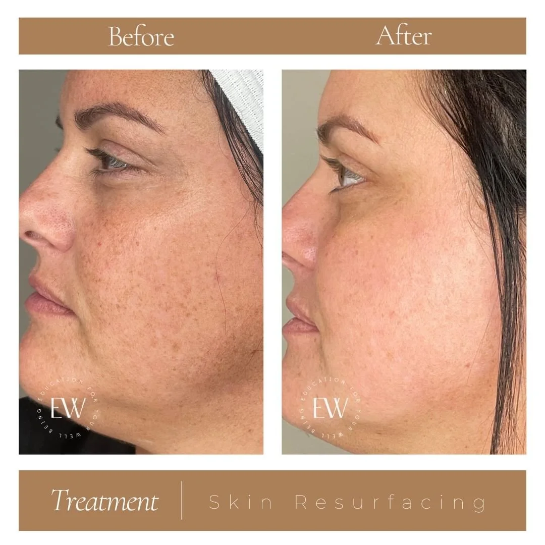 Fotona 4D Laser Before and Afters — Elivate Wellness
