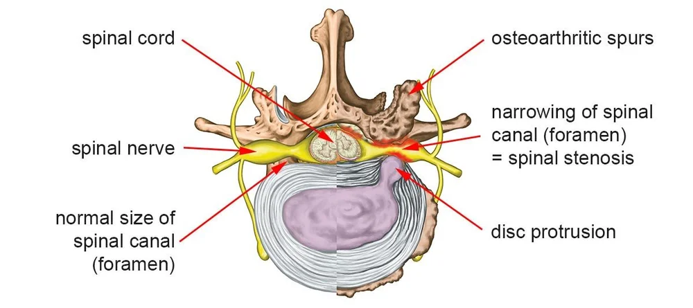 How Spinal Decompression Treats Foraminal Stenosis Without Surgery or ...