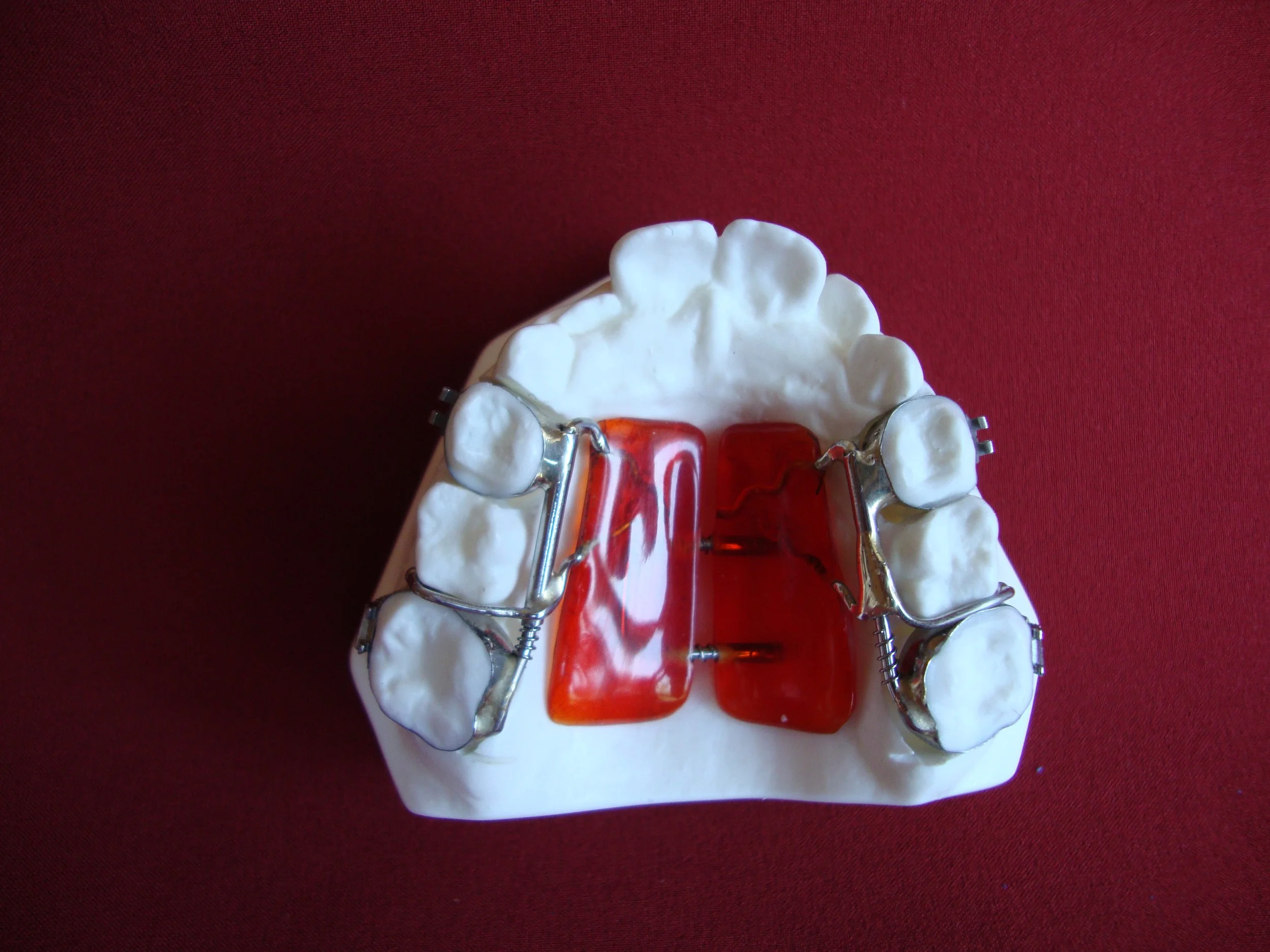 Expanders — Jump Smile Orthodontics