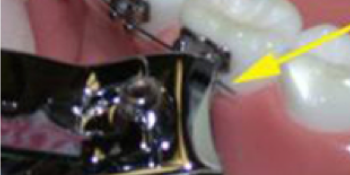 Tips for poking wires — Jump Smile Orthodontics