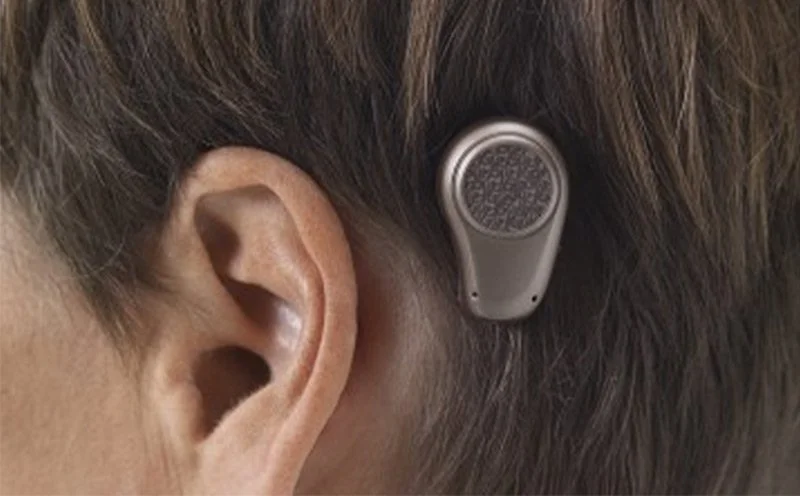 Bone Anchored Hearing Aids