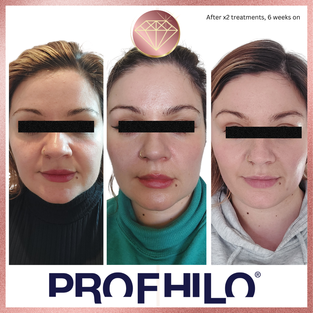 Prohfilo Treatments — Diamond Beauty Clinic Dublin