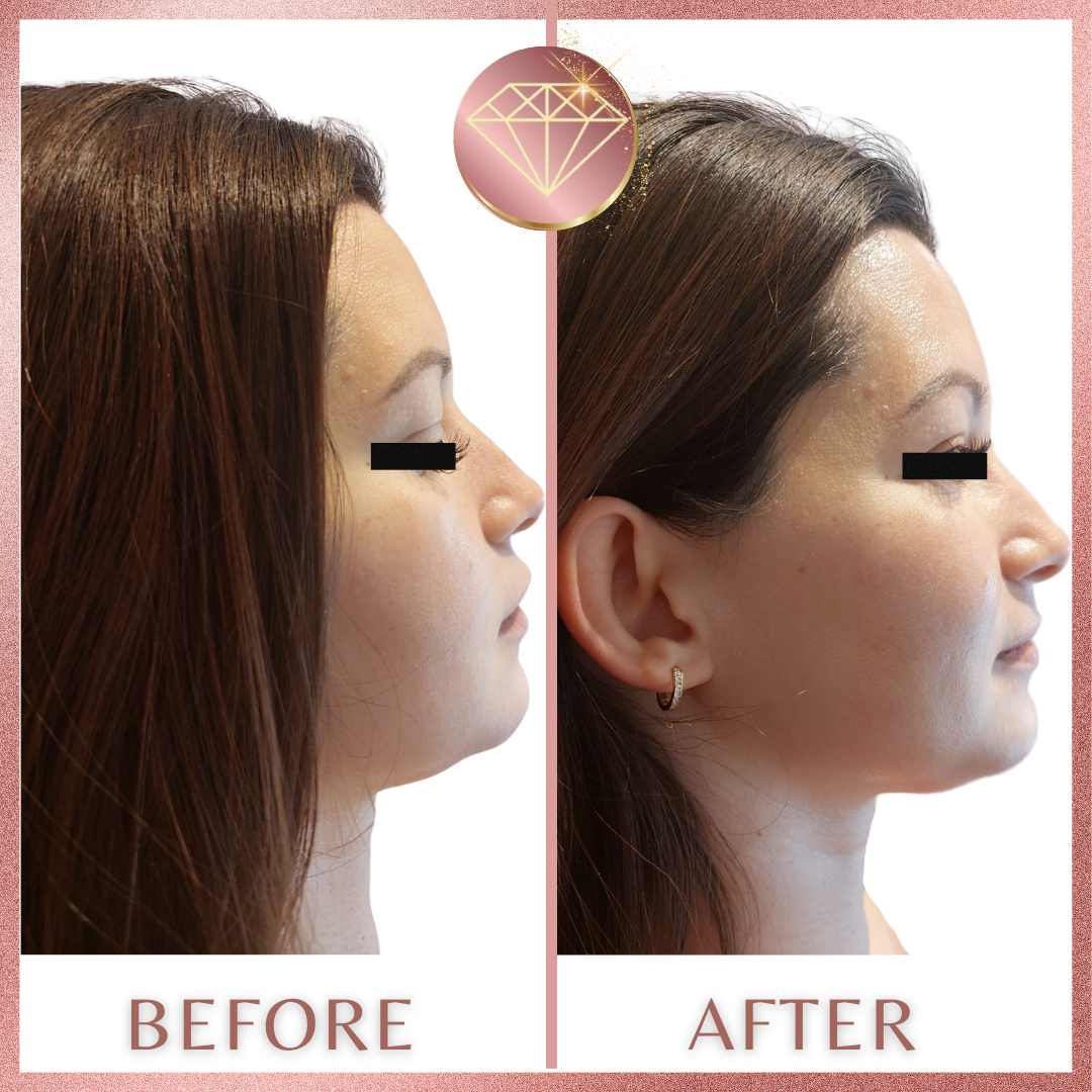 HIFU Face & Body — Diamond Beauty Clinic Dublin