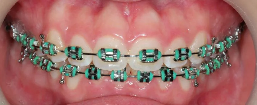 Common Orthodontic Issues and How We Fix Them | Textbook Orthodontics