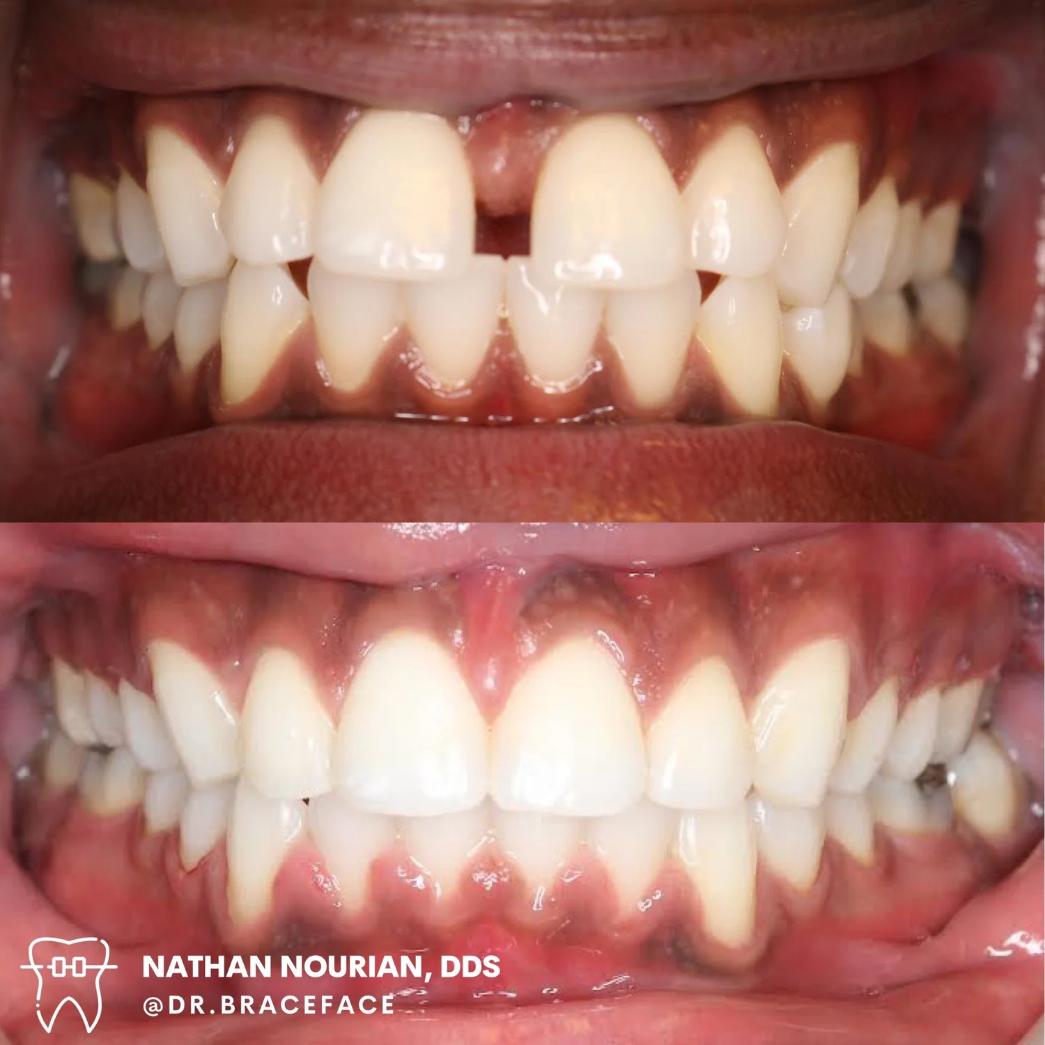 before-after-orthodontic-cases