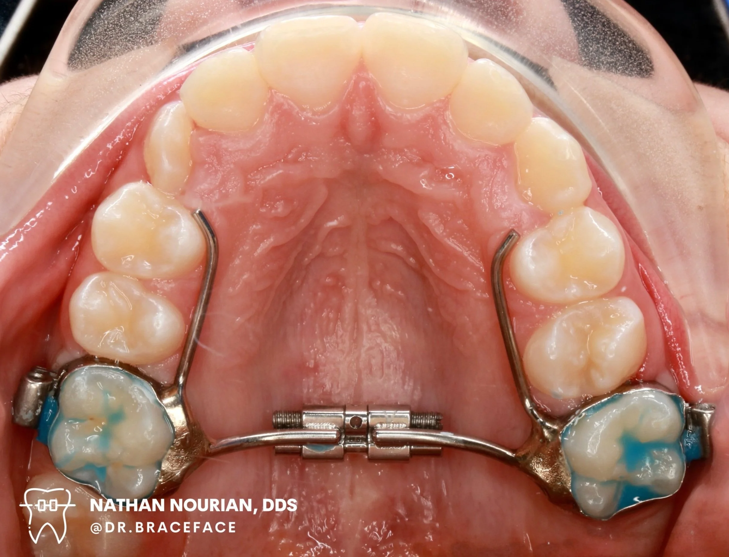 Palatal Expander In Los Angeles, CA