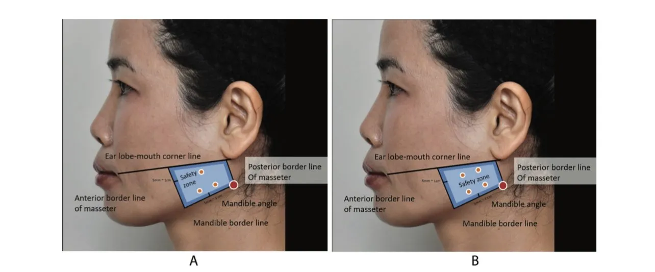 TMJ Botox In North York For Lasting Relief — Forest Manor Dental