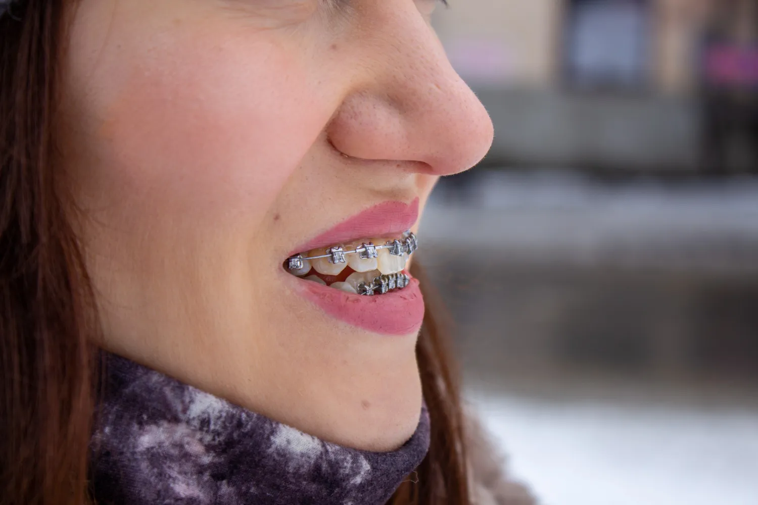 Restoring Harmony with TMJ Treatment Braces - Forest Manor Dental