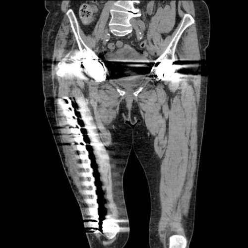 Case 14 Revision Of A Recurrently Dislocating Hip With Large Acetabular Defect Using A Custom
