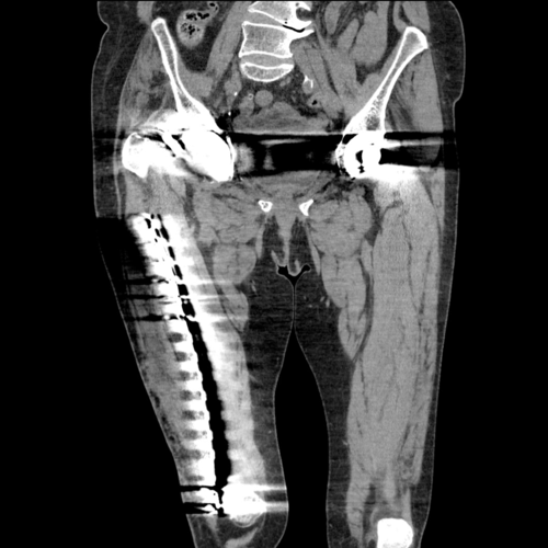 Case 14 Revision Of A Recurrently Dislocating Hip With Large Acetabular Defect Using A Custom