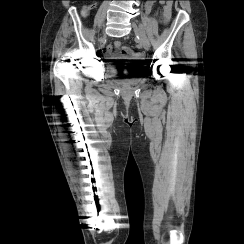CASE 14: Revision of a recurrently dislocating hip with large ...