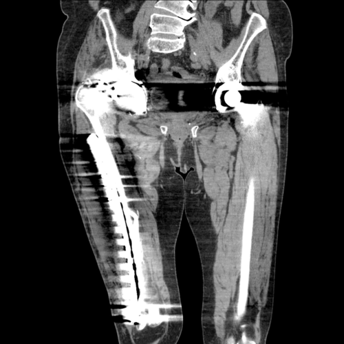 CASE 14: Revision of a recurrently dislocating hip with large ...