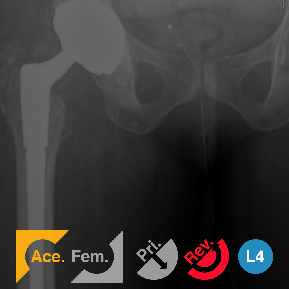 Cases — Complex Hip Surgery