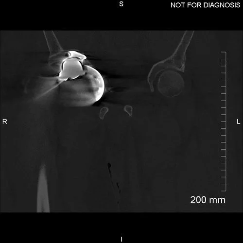 CASE 29: Re Revision of a intra-pelvic cup due to periprosthetic ...