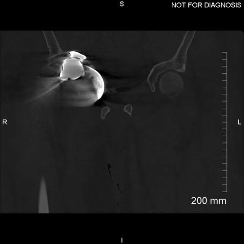 CASE 29: Re Revision of a intra-pelvic cup due to periprosthetic ...