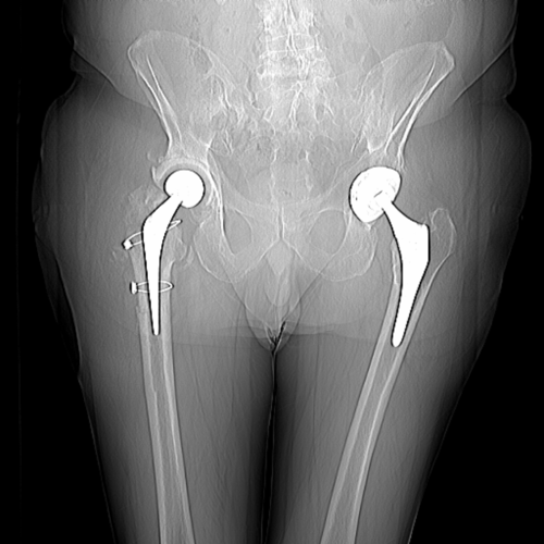 CASE 38: Revision for infection using a standard cup and 3D printed ...