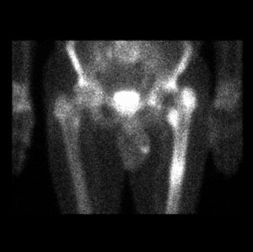 CASE 39: Revision of a loose stem using a modular taper fluted stem ...