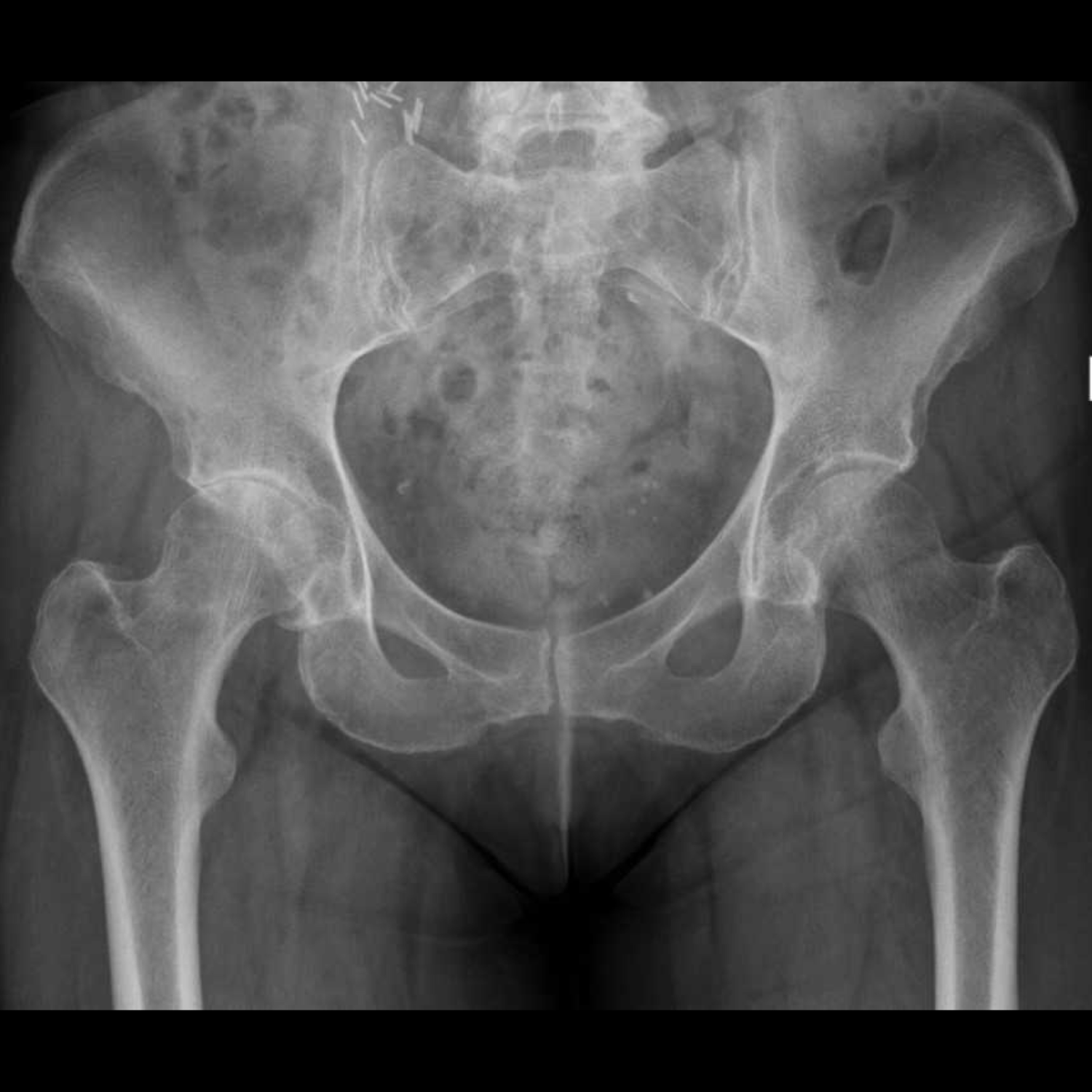 CASE 43: Using 3D printed guides to achieve the best possible position ...