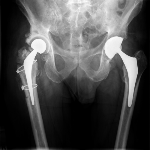 CASE 38: Revision for infection using a standard cup and 3D printed ...