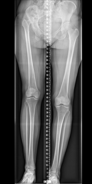 CASE 19: Complex primary hip replacement for severe (Crowe Grade 4) hip ...