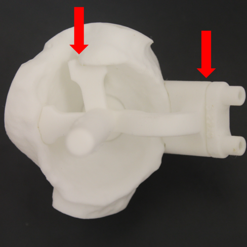 CASE 38: Revision for infection using a standard cup and 3D printed ...