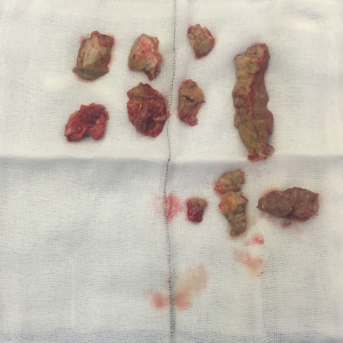 CASE 17: Revision surgery for a dislocating hip replacement, using a ...