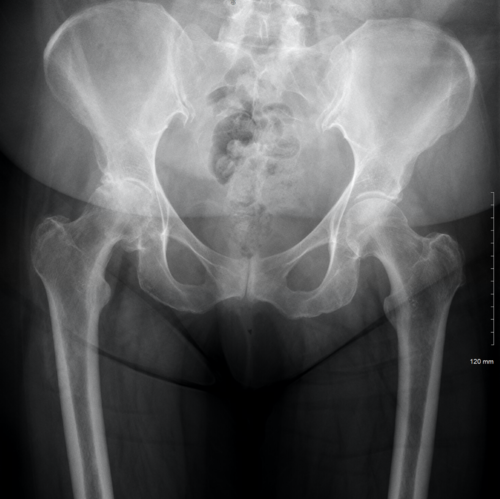 CASE 2: Robotic assisted primary hip replacement, with post-operative ...